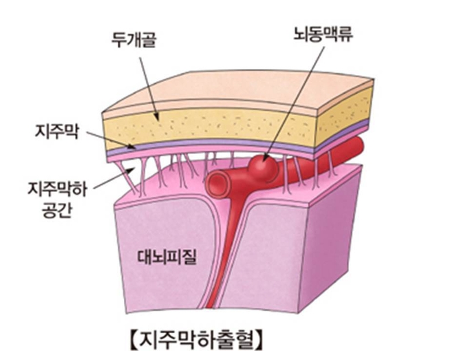 뇌졸중 지주막하 출혈 미국서 매년 07씩↑뇌 영상 촬영 증가가 원인